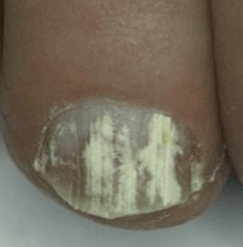 Onychomycose : Est-ce vraiment une mycose sur mes ongles? - phyto-soins.com