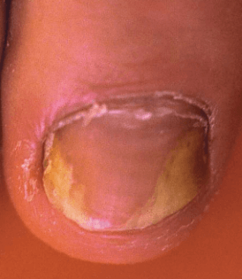 Onychomycose : Est-ce vraiment une mycose sur mes ongles? - phyto-soins.com