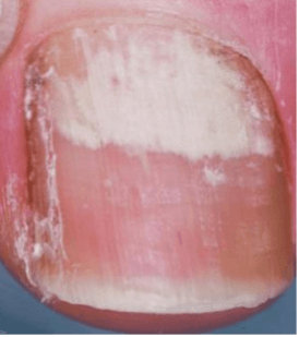 Onychomycose : Est-ce vraiment une mycose sur mes ongles? - phyto-soins.com